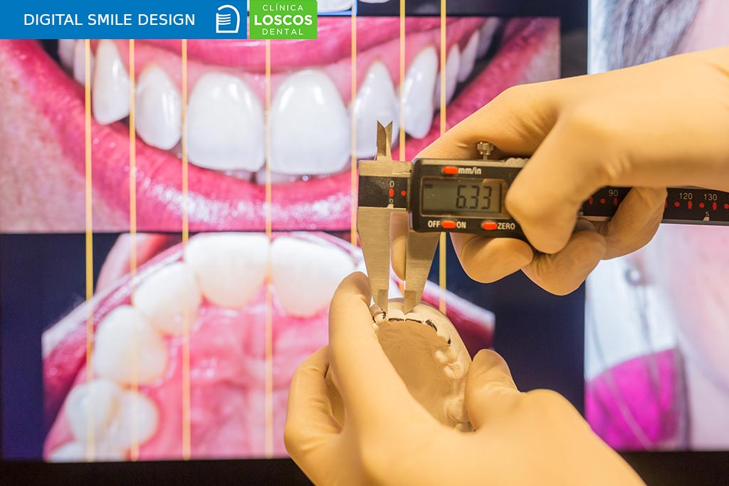 Digital Smile Design - DSD | Dental Clinic Loscos